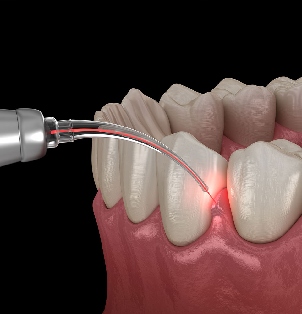 Gum Disease Treatment | Hazlet, NJ | Glenwood Dental Group
